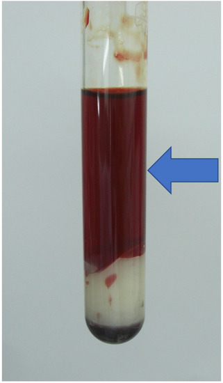 Clinical and Microbiological Features of Fulminant Haemolysis Caused by ...