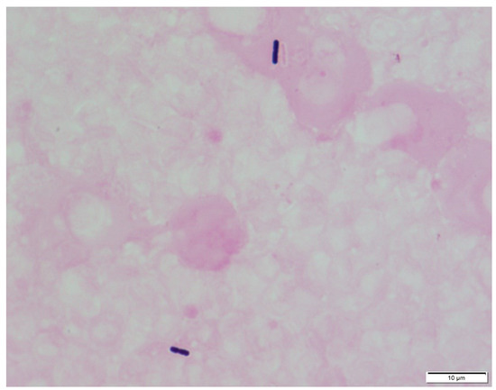 Clinical and Microbiological Features of Fulminant Haemolysis Caused by ...