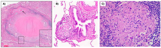 Sarcoidosis, Mycobacterium paratuberculosis and Noncaseating Granulomas ...