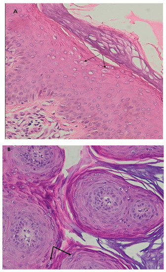 Atypical Cutaneous Viral Infections Reveal an Inborn Error of Immunity ...