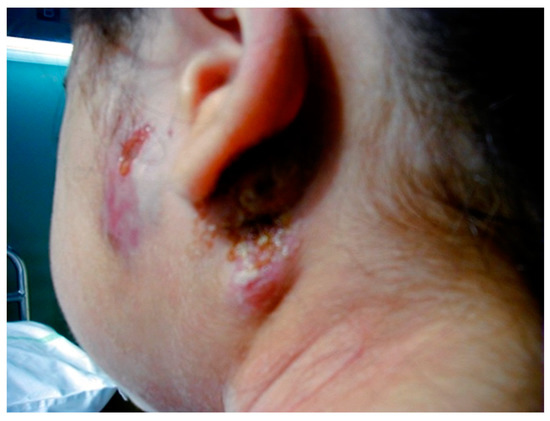 Microorganisms | Free Full-Text | Pulmonary Tuberculosis in Children: A ...