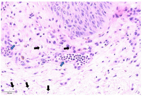 Monkeypox: A Histopathological and Transmission Electron Microscopy Study