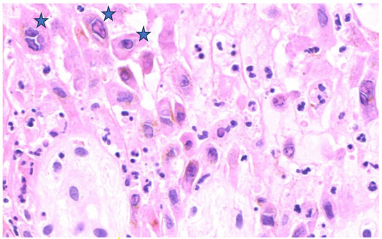Monkeypox: A Histopathological and Transmission Electron Microscopy Study