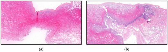 Diagnostic and Management of Emphysematous Hepatitis with Emphasis on ...