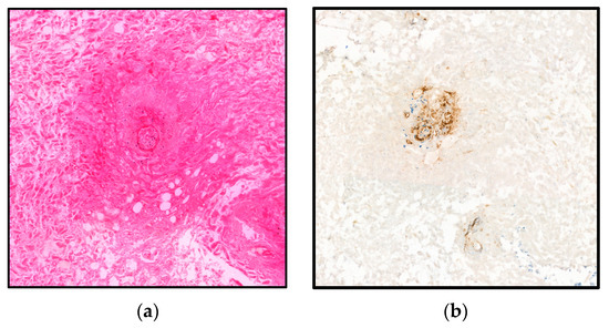 Diagnostic and Management of Emphysematous Hepatitis with Emphasis on ...