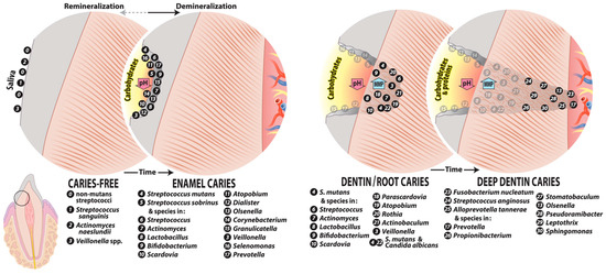 The Evolving Microbiome of Dental Caries