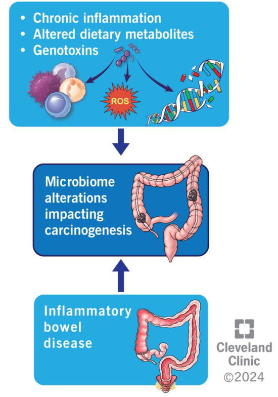 Gut Microbiome–Colorectal Cancer Relationship