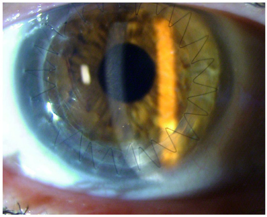 Understanding Acanthamoeba Keratitis: An In-Depth Review of a Sight ...