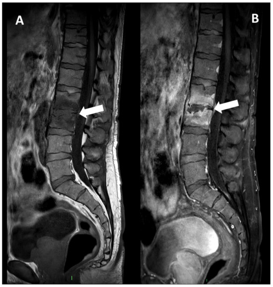 Microorganisms | Free Full-Text | Imaging of Spondylodiscitis: A Comprehensive Updated Review ...