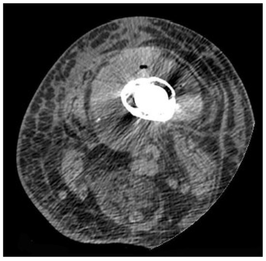 Imaging in Periprosthetic Joint Infection Diagnosis: A Comprehensive Review