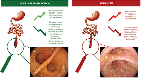 Role of Probiotics in the Management of Patients with Ulcerative ...