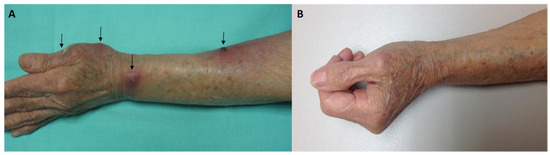 Primary Cutaneous Nocardiosis (Lymphangitic Type) in an Immunocompetent ...