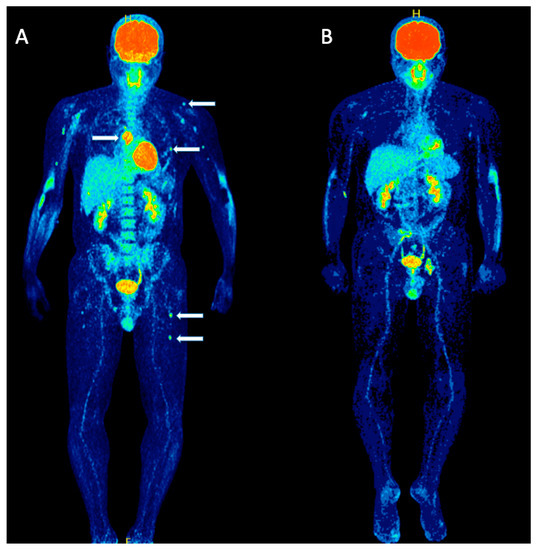 Positron Emission Tomography (PET) Radiopharmaceuticals in Multiple Myeloma