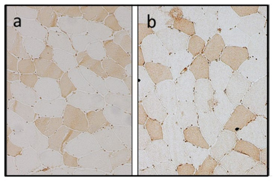 Muscle Carnitine Palmitoyltransferase II (CPT II) Deficiency: A ...