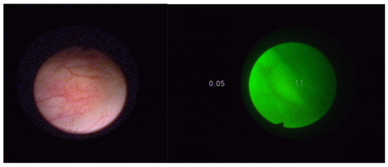 Advances in Management of Bladder Cancer—The Role of Photodynamic Therapy