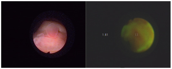 Advances in Management of Bladder Cancer—The Role of Photodynamic Therapy