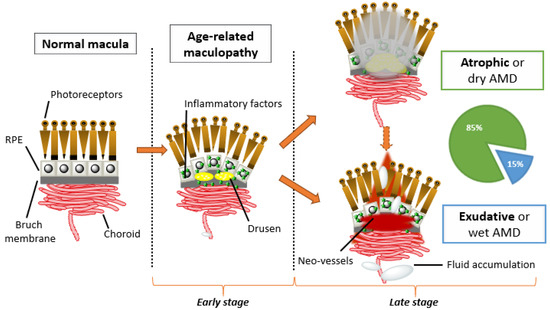 Recent Advances in Age-Related Macular Degeneration Therapies