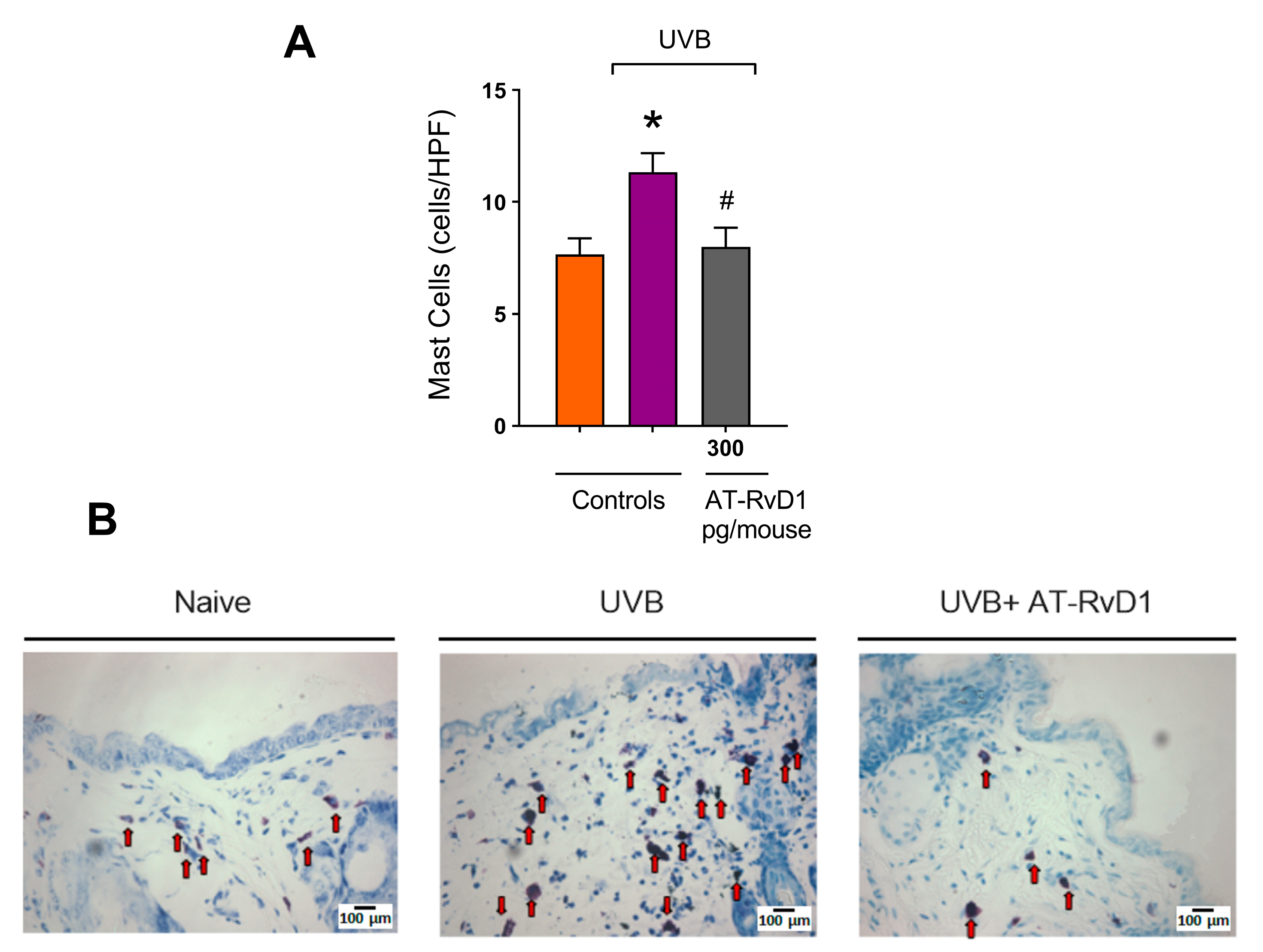 Aspirin-Triggered Resolvin D1 (AT-RvD1) Protects Mouse Skin against UVB ...