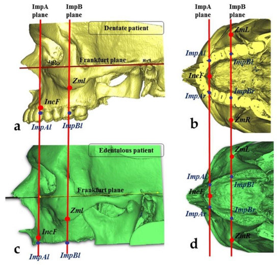 Three-Dimensional Radiographic Evaluation of the Malar Bone Engagement ...