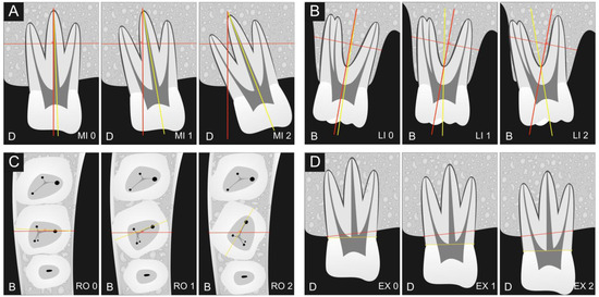 Correlation between Tooth Position Parameters and Apical Fenestration ...