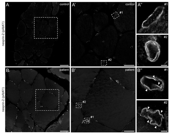 An Intronic Heterozygous SYNE2 Splice Site Mutation: A Rare Cause for ...