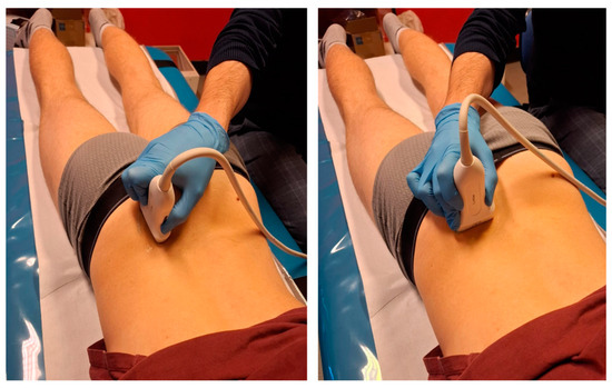 Posterior Hip Pointer: Subperiosteal Detachment of the Gluteal Muscles at the Posterior Iliac ...