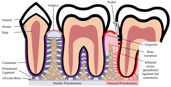 Recent Advances on Electrospun Nanofibers for Periodontal Regeneration