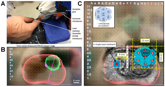 A Detailed Clinical Case of Localized Prostate Tumors Treated with ...