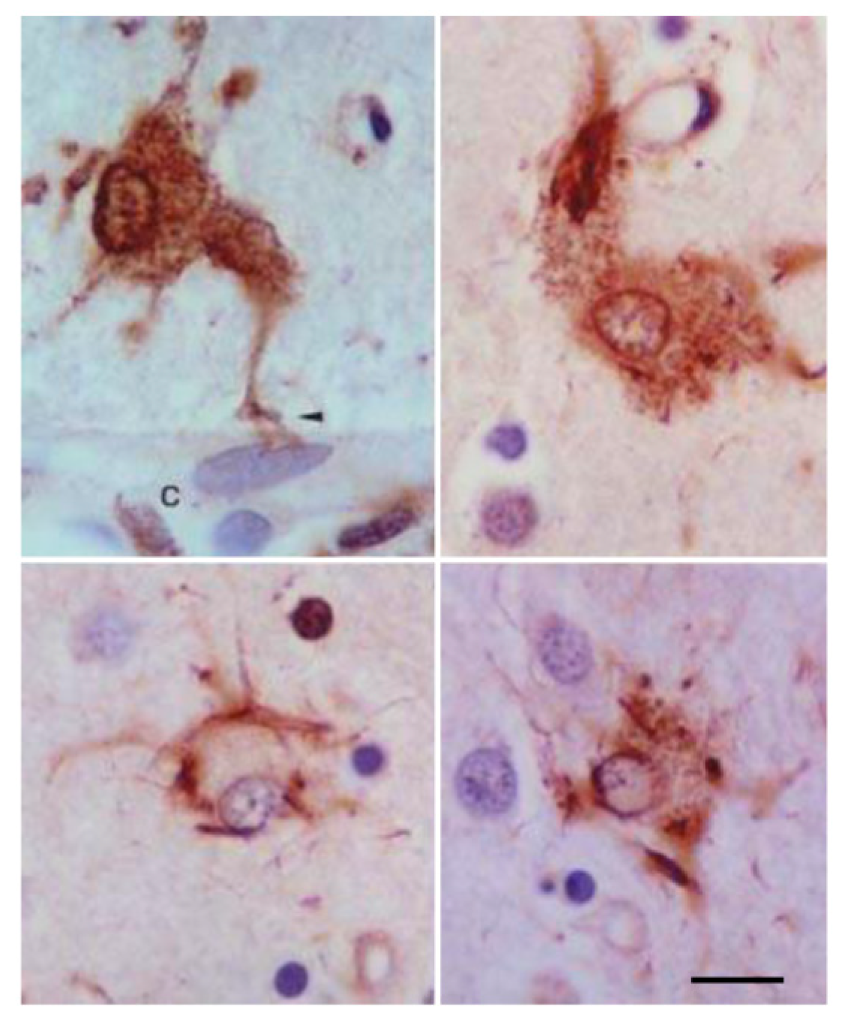 Astrogliopathy in Tauopathies