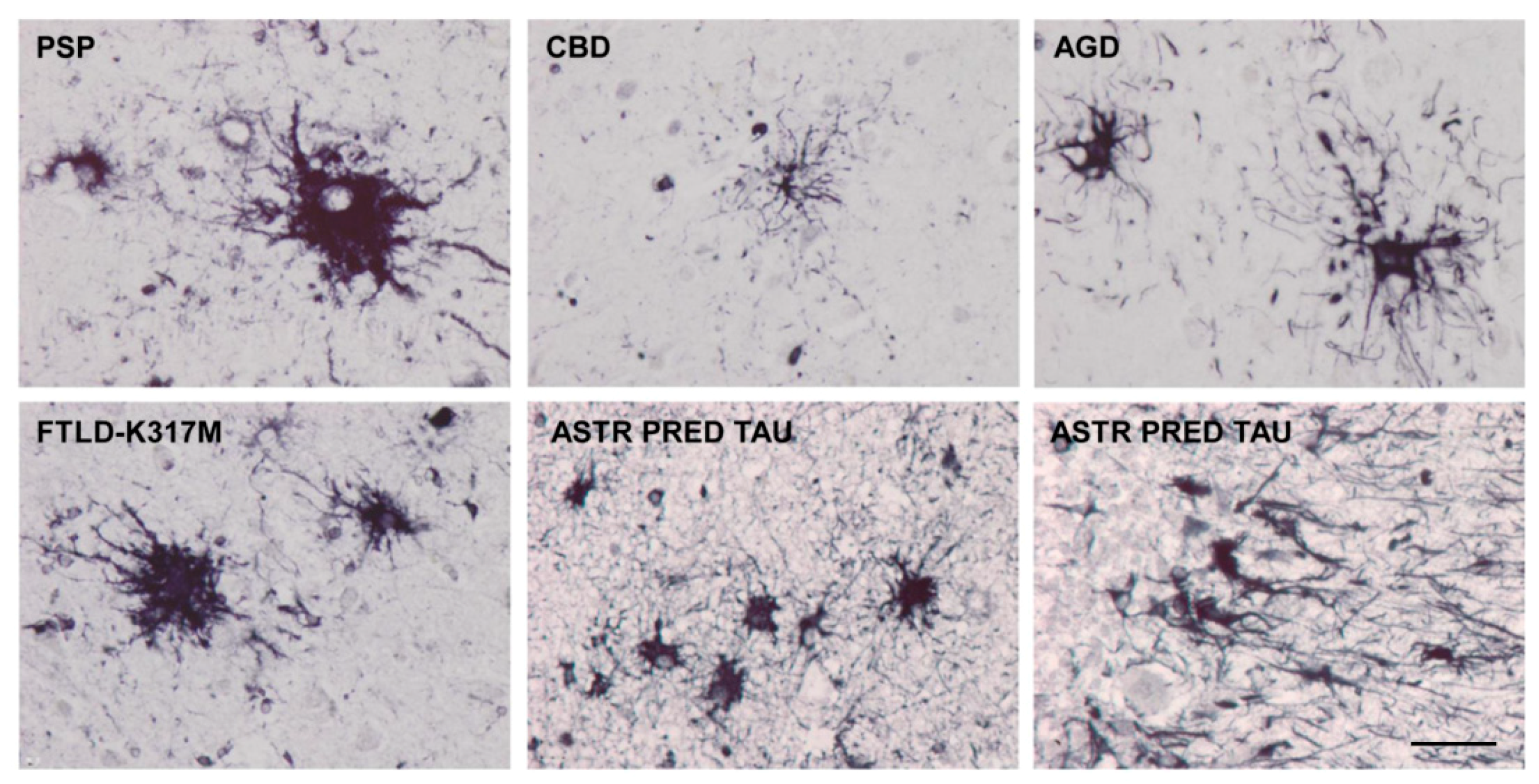 Astrogliopathy in Tauopathies