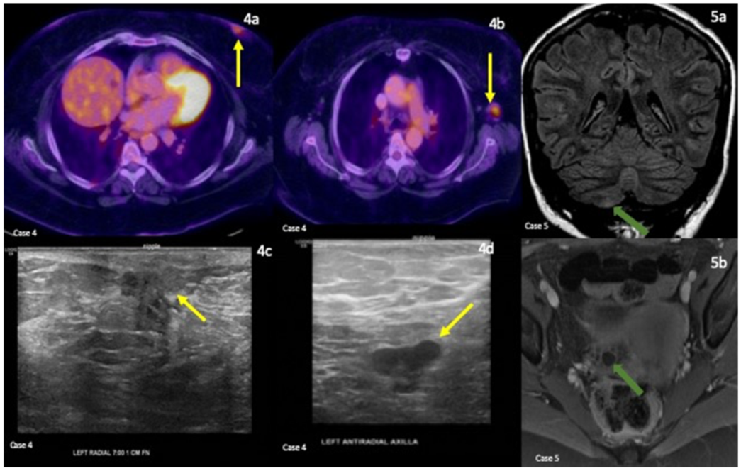 Neuroimaging and CSF Findings in Patients with Autoimmune Encephalitis ...