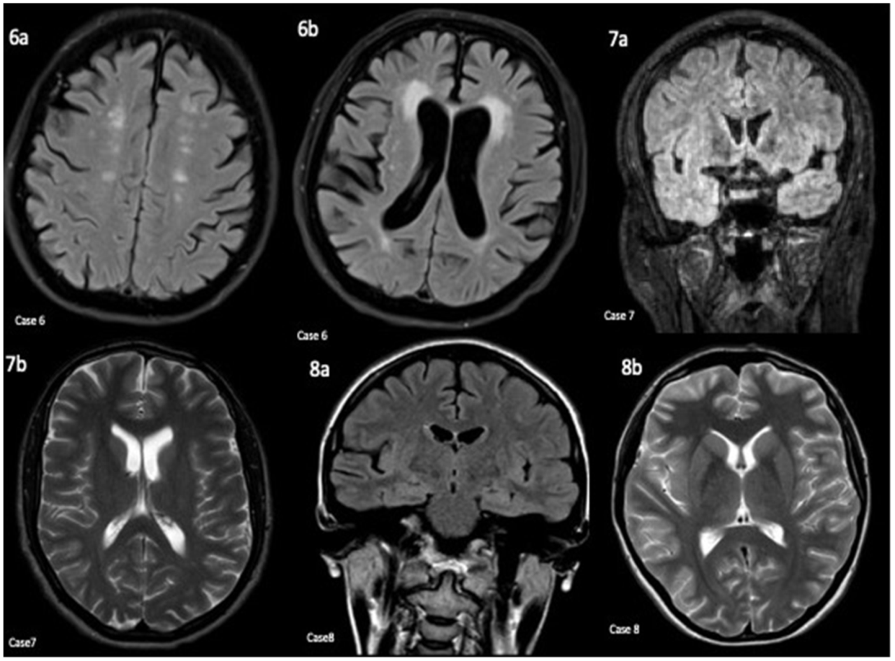 Neuroimaging and CSF Findings in Patients with Autoimmune Encephalitis ...