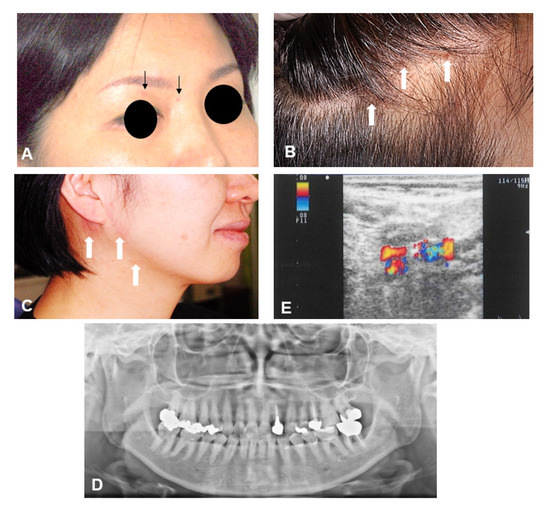 Trigeminal Herpes Zoster Transited to Ipsilateral Occipital Neuralgia