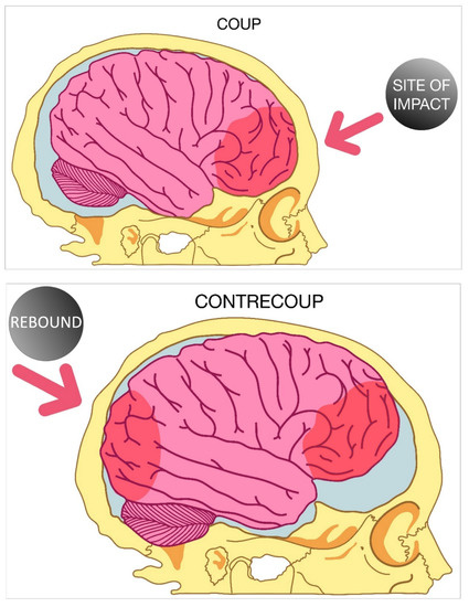 Left Frontal Lobe Brain Injury Frontal Lobe Injury Causes A Wide