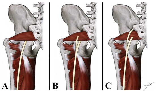 Anatomical Variations of the Sciatic Nerve Exit from the Pelvis and Its ...