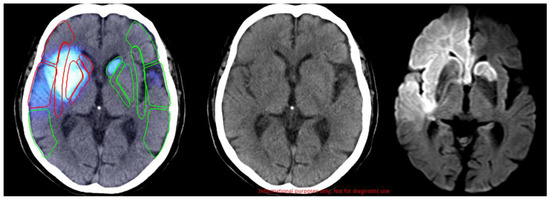 The Utility of Automated ASPECTS in Acute Ischemic Stroke for ...