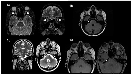 Anti-MOG Positive Bilateral Optic Neuritis and Brainstem Encephalitis ...