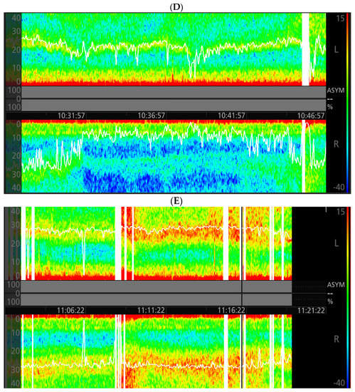 Hemispheric Asymmetry on the Electroencephalogram during General ...