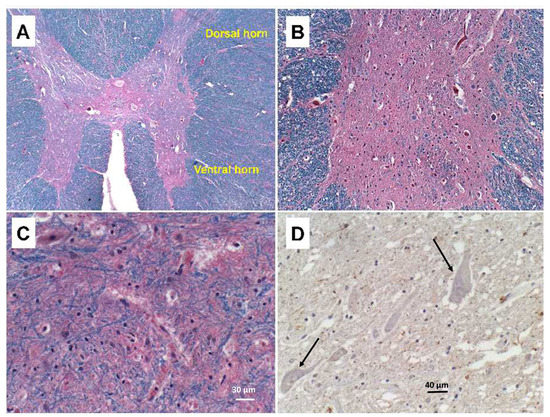 Post-Polio Syndrome Revisited