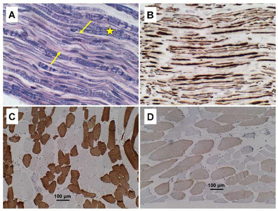 Post-Polio Syndrome Revisited