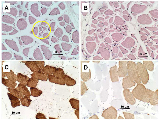 Post-Polio Syndrome Revisited