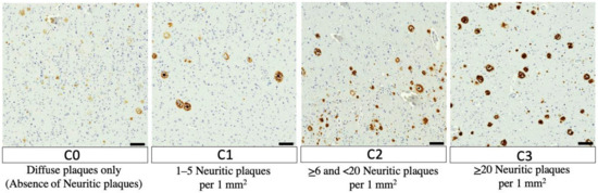 Illustrated Neuropathologic Diagnosis of Alzheimer’s Disease
