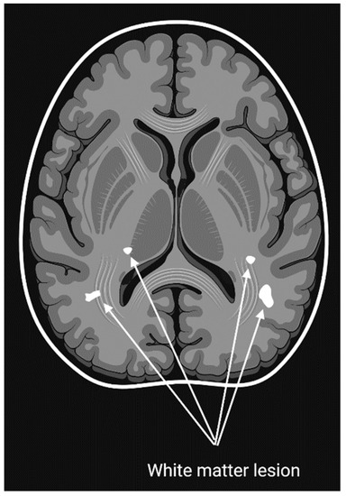 Migraine: Advances in the Pathogenesis and Treatment