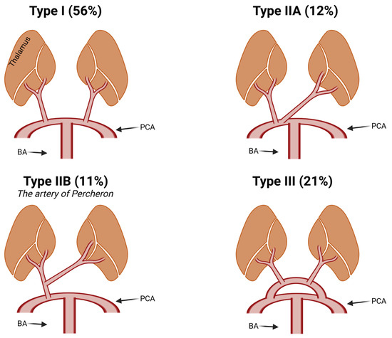 A Case Series of Four Patients with Artery of Percheron Occlusion over ...