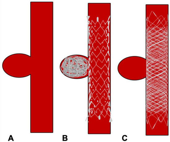The Management of Intracranial Aneurysms: Current Trends and Future ...