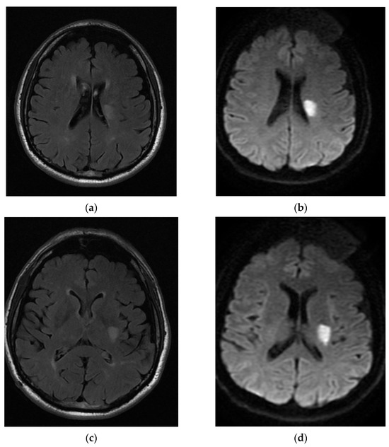 Acute Anterior Choroidal Artery Territory Infarction: A Case Series Report