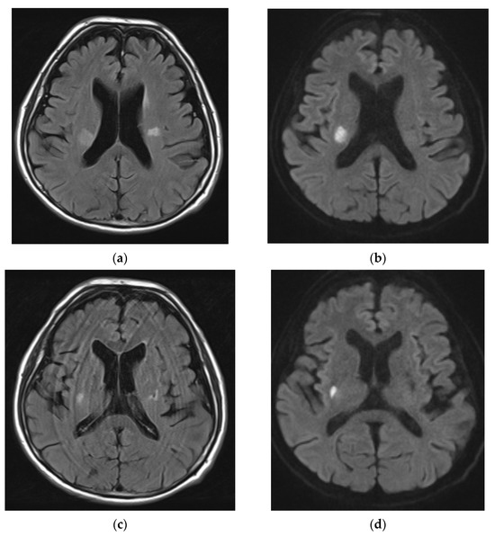 Acute Anterior Choroidal Artery Territory Infarction: A Case Series Report