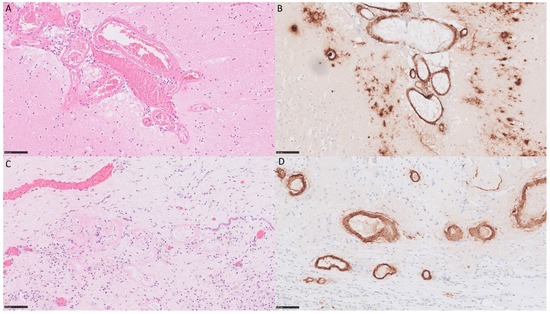 Recurrent Intracerebral Haematomas Due to Amyloid Angyopathy after ...