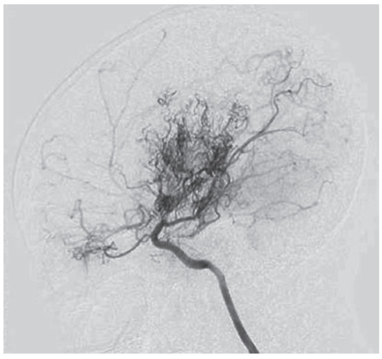 Clinical Case of a 23-Year-Old Patient with Moyamoya Disease and ...