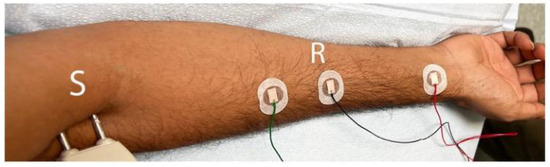 A Retrospective Study of Lateral Antebrachial Cutaneous Nerve ...